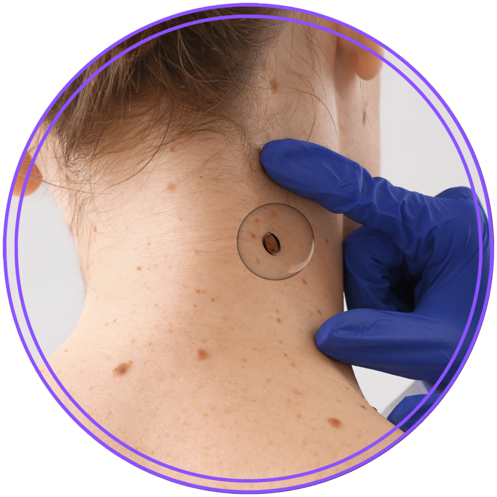 Non-Invasive Genetic Sticker - ImmunoHub.org - Immuno-Oncology Essentials